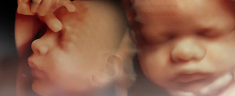 Ultrasona Fetal Fotos - Unparalleled HD Live & 3D/4D Ultrasound Imaging ...